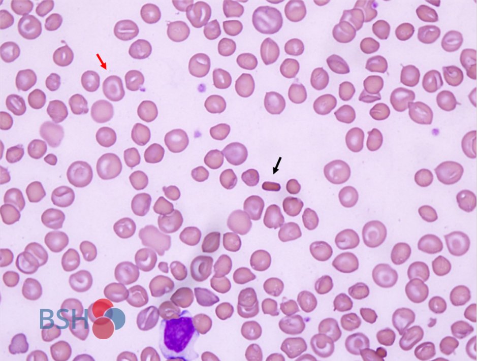 Haematology images | British Society for Haematology
