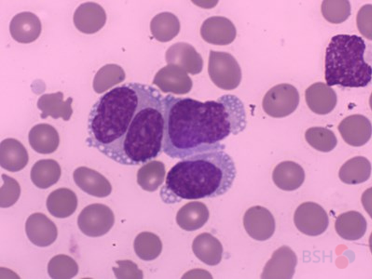 Haematology images | British Society for Haematology