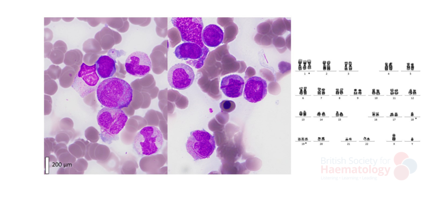 Haematology images | British Society for Haematology